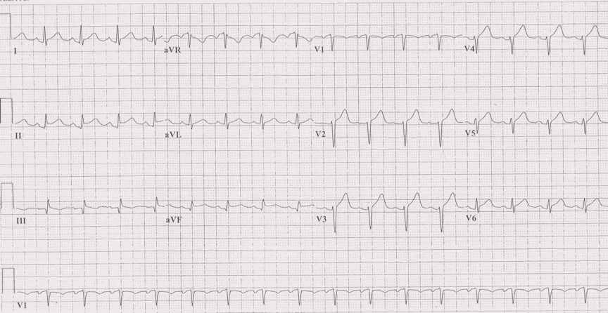 EKG 12 Lead Analysis and Interpretation Practice Quiz
