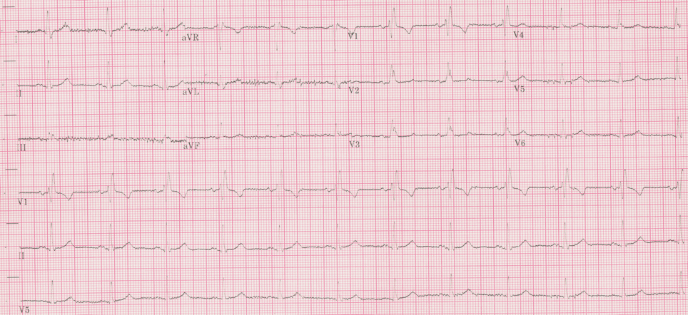 EKG 12 Lead Analysis and Interpretation Practice Quiz
