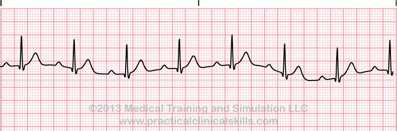 EKG Practice Drill