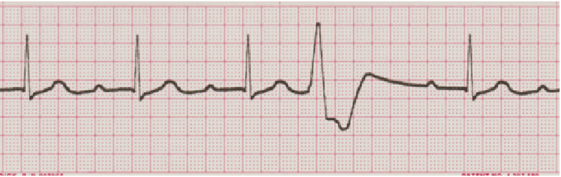 EKG Practice Strips