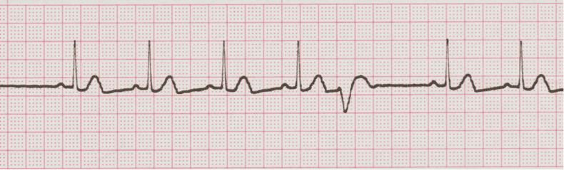 EKG Practice Drill