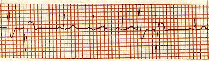 Comprehensive ECG Quiz | Multiple Choice Graded Quiz